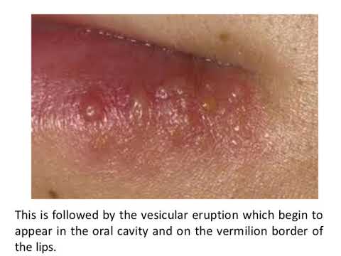 Primary Herpetic Gingivostomatitis - YouTube