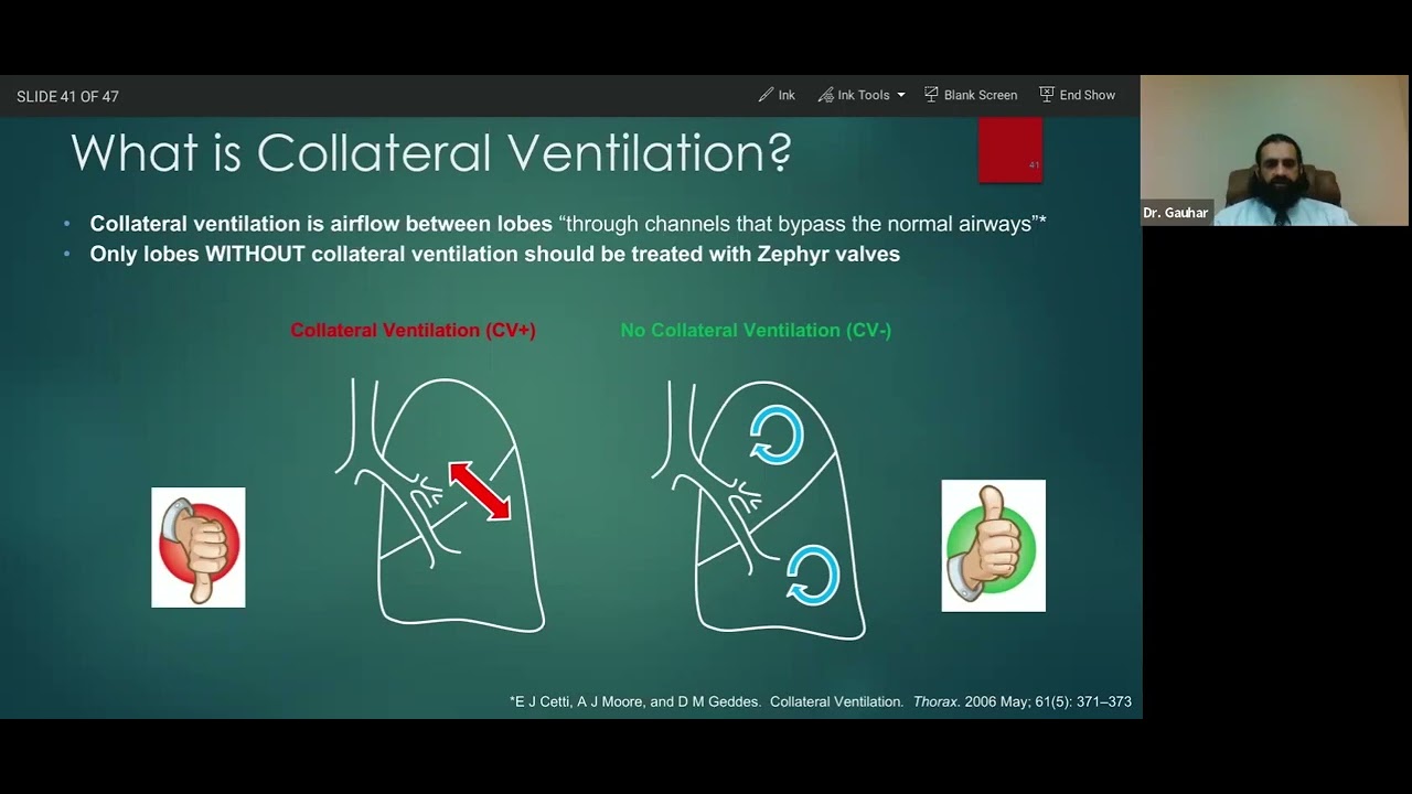 Physician Perspective: Dr. Gauhar Explains Collateral Ventilation CV ...