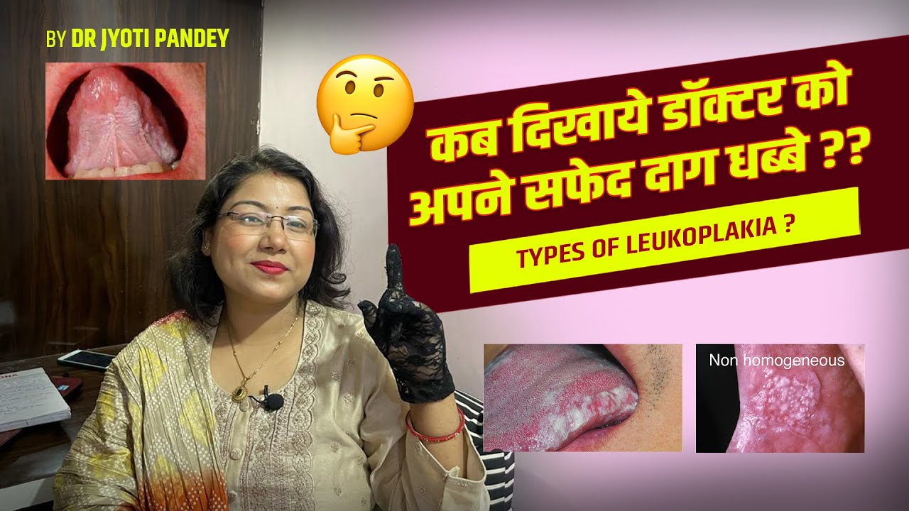 कब दिखाये डॉक्टर को अपने सफेद दाग धब्बे ?? Types of LEUKOPLAKIA… - YouTube