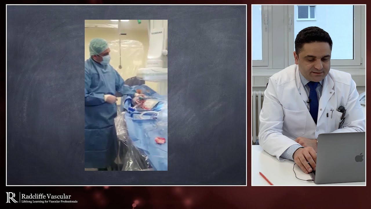 Treating calcified lesions using the Shockwave Lithoplasty® System ...