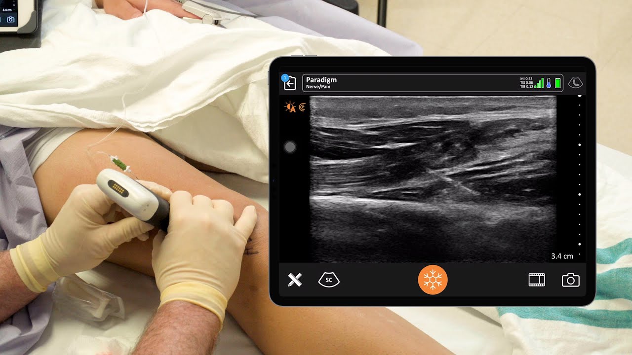 ACL Block #2 - Genicular Nerve - YouTube