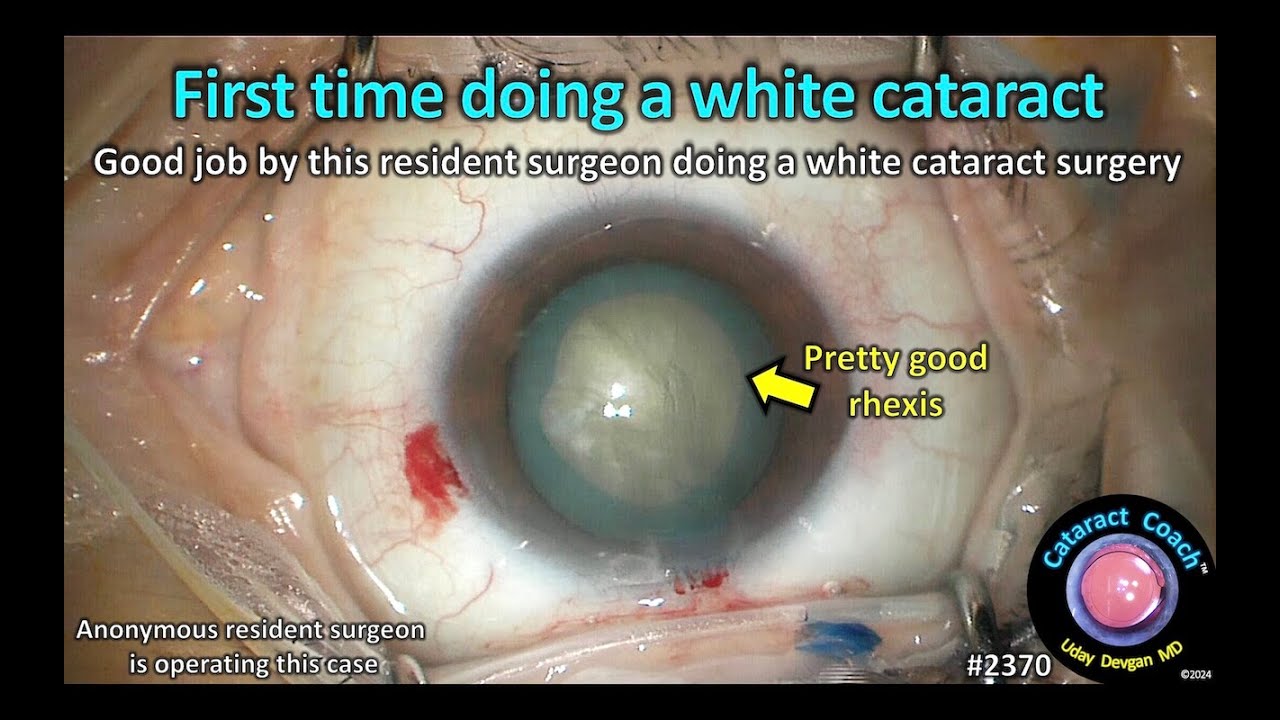 CataractCoach™ 2370: first time doing a white cataract - YouTube