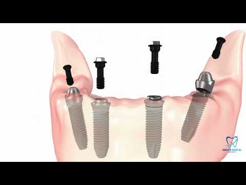 Smiley Dental | Antalya Diş Kliniği | All On 4 Diş İmplantları | Prosedür Animasyonu