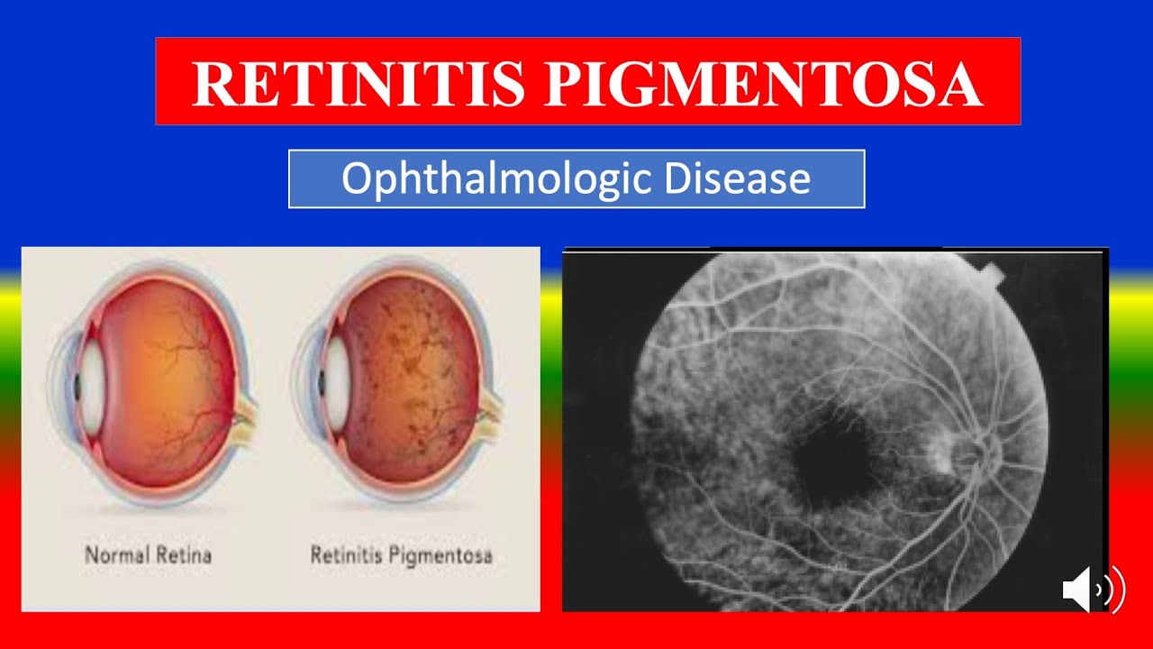 RETINITIS PIGMENTOSA - Definition, types, causes, pathophysiology ...