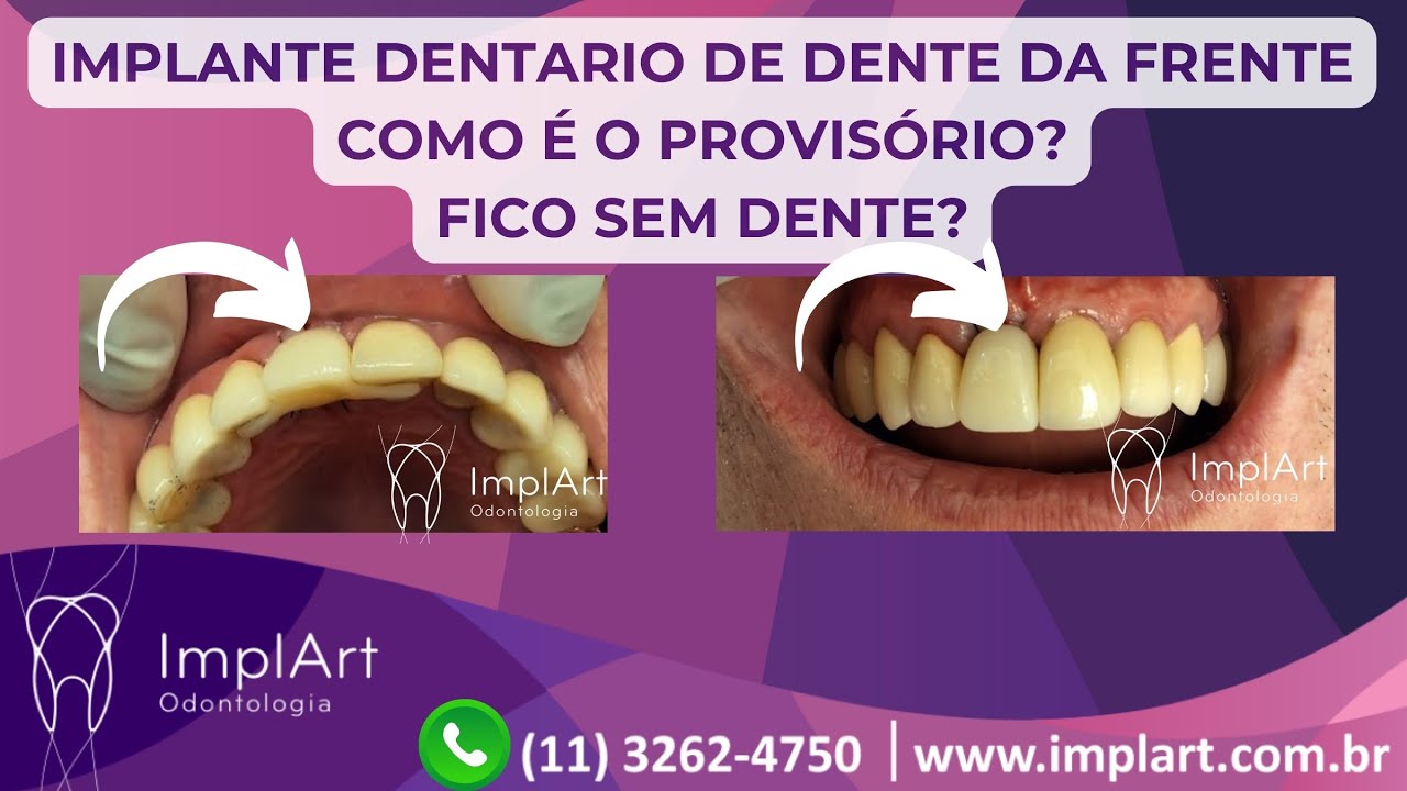 IMPLANTE DENTARIO DENTE DA FRENTE - COMO É O PROVISÓRIO? FICO SEM DENTE ...