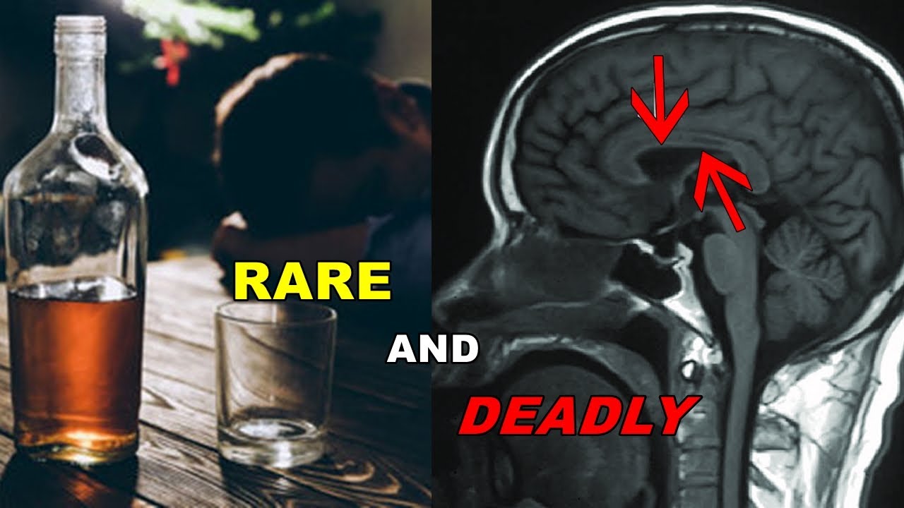 The DEADLY Alcohol-Induced Brain Disease You've NEVER Heard Of ...