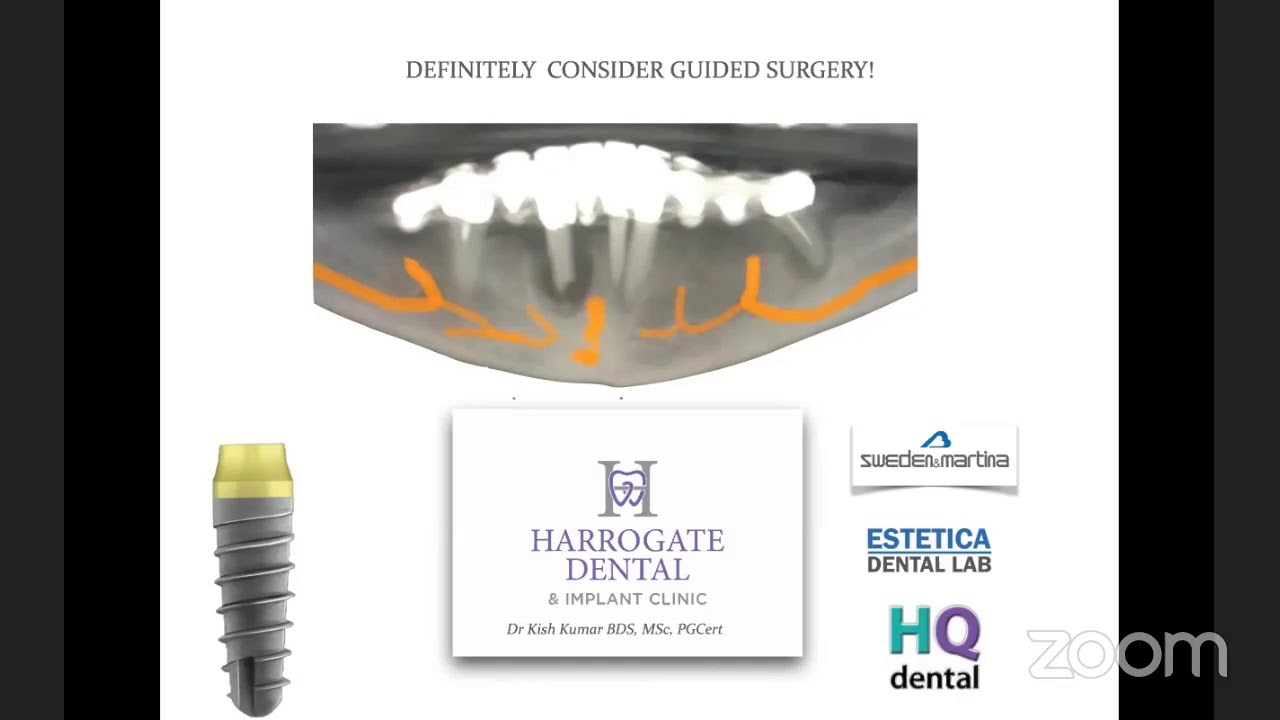 FULL DIGITAL WORKFLOW IN IMPLANT DENTISTRY - YouTube