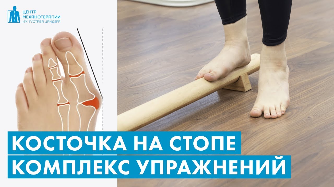 Косточка на стопе комплекс упражнений Youtube