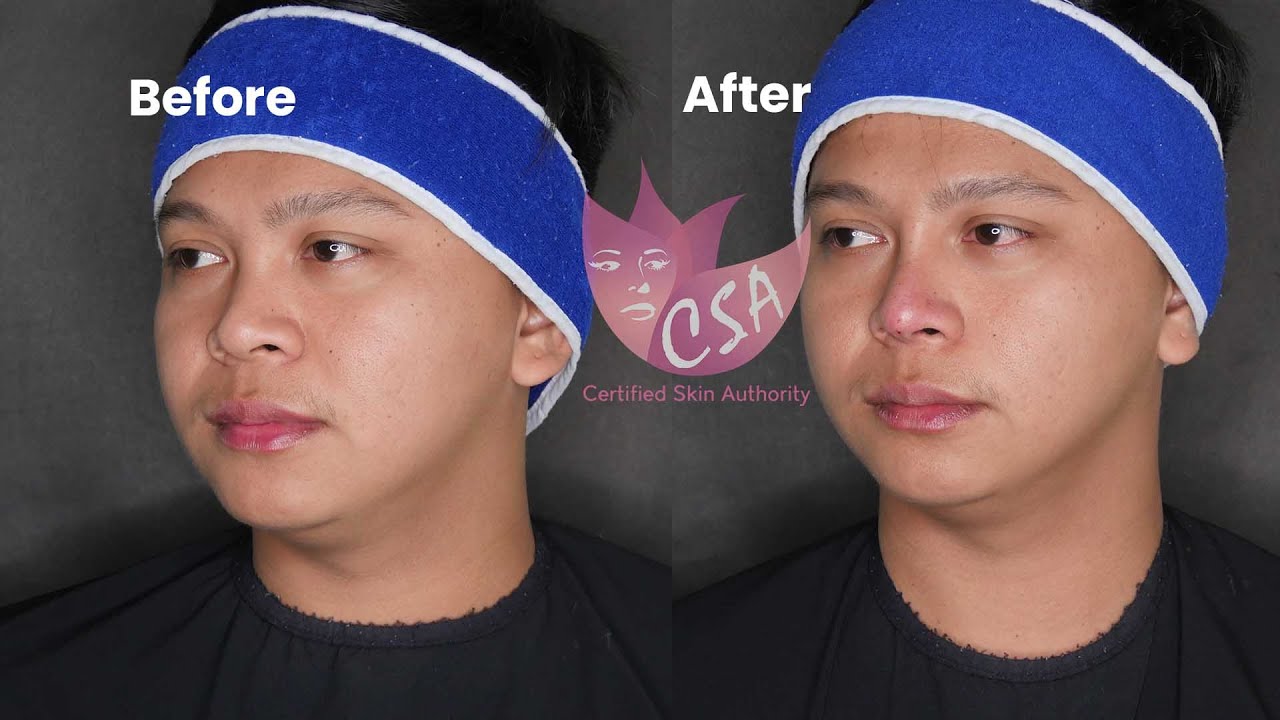 INSTANT NOSELIFT USING THREADS FOR MEN - YouTube