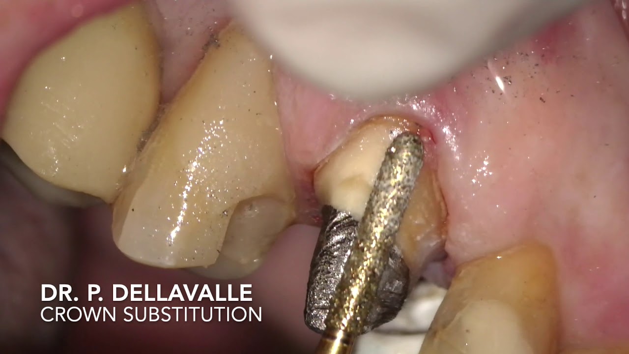 Crown removal and prep - YouTube