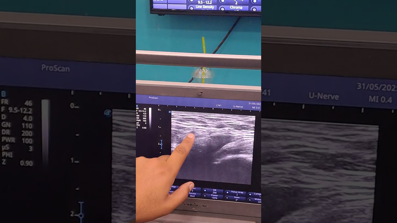 Us Guided Genitofemoral Nerve Block Youtube