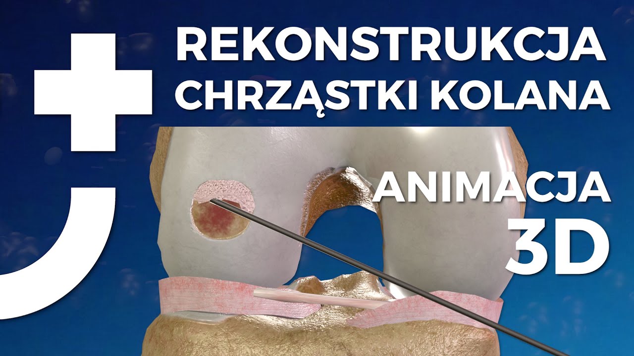 Rekonstrukcja chrząstki kolana - animacja 3D - Nowa Ortopedia - YouTube