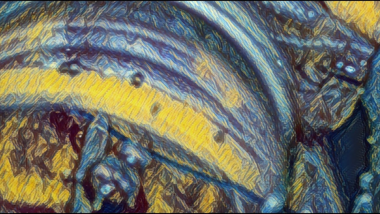 PHACO+GATT (… + Minor PCR) - Routine POAG - YouTube