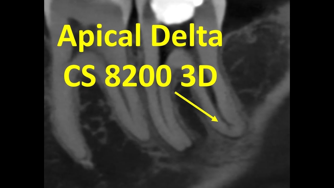 CS 3D Imaging - Apical Delta - YouTube