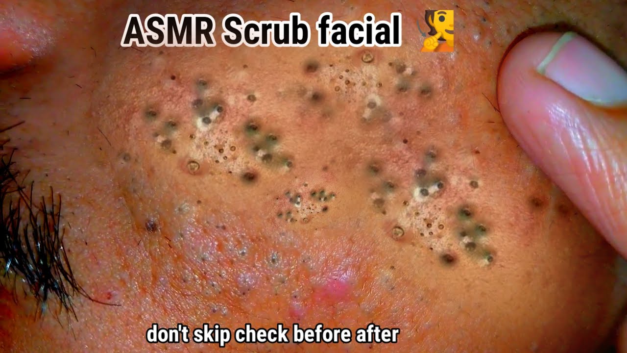 sac be spa blackheads elderly 2025 | sac be spa boy age blackheads 2025 ...