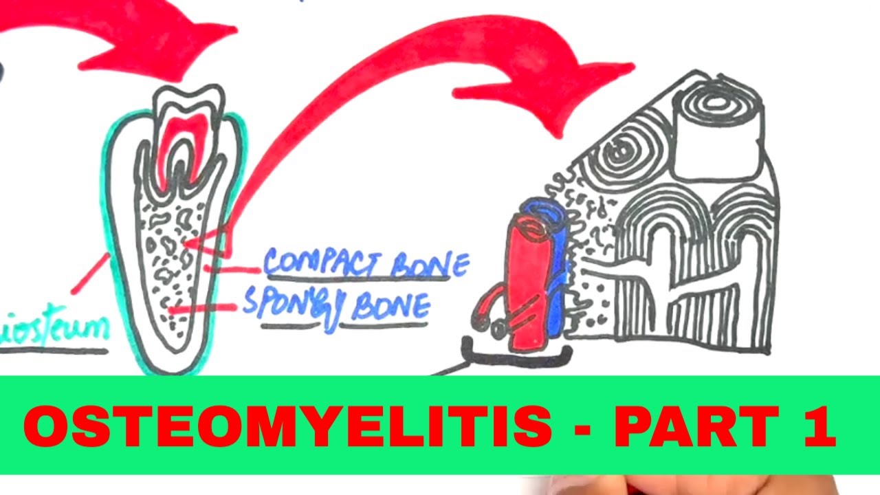 Osteomyelitis - Causes, Pathophysiology, Clinical Features & Treatment ...