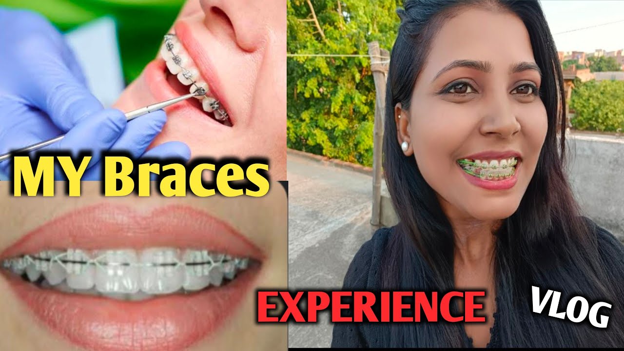 My Braces experience/Dental Braces Treatment- Cost |Types Of Braces | Nd Family Vlogs - YouTube
