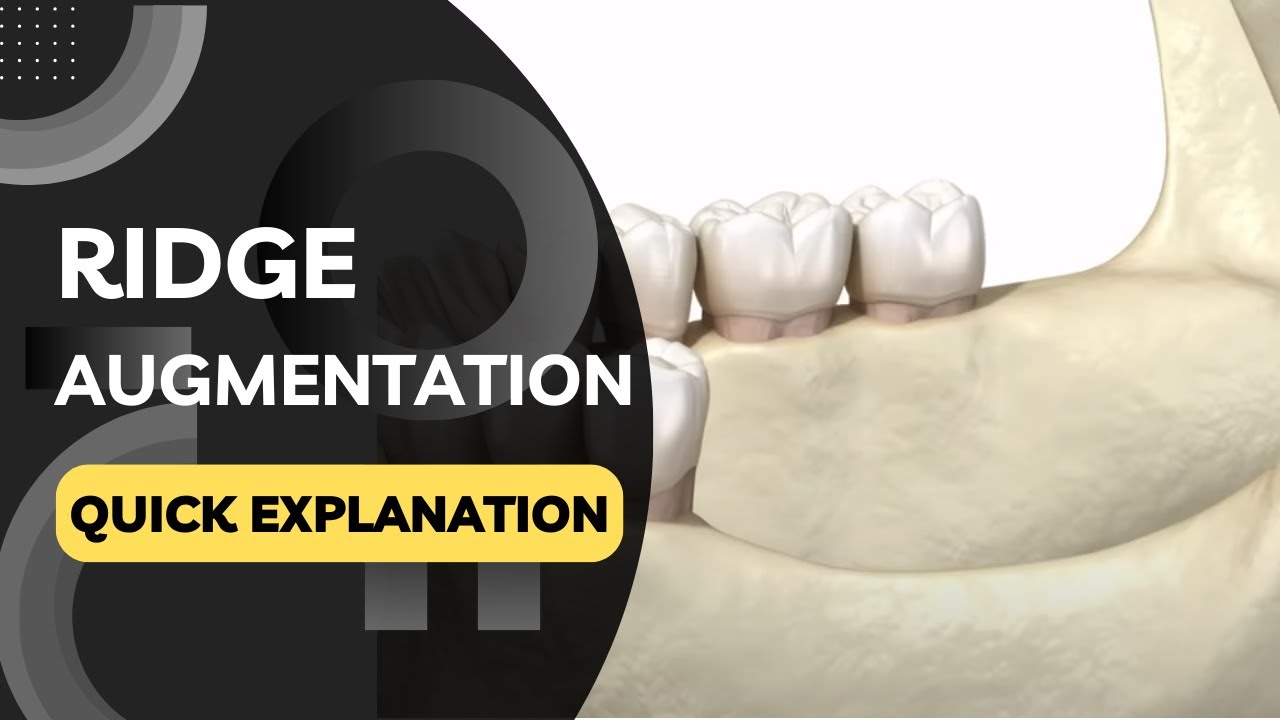 What is Ridge Augmentation? Quickly Explained in a Few Seconds! - YouTube