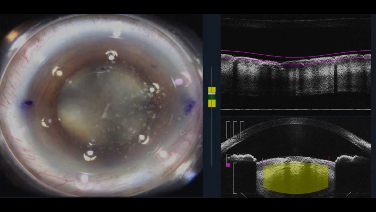 Complicated Cataract Surgery Use Lensx In A Brunescent Hyper Mature