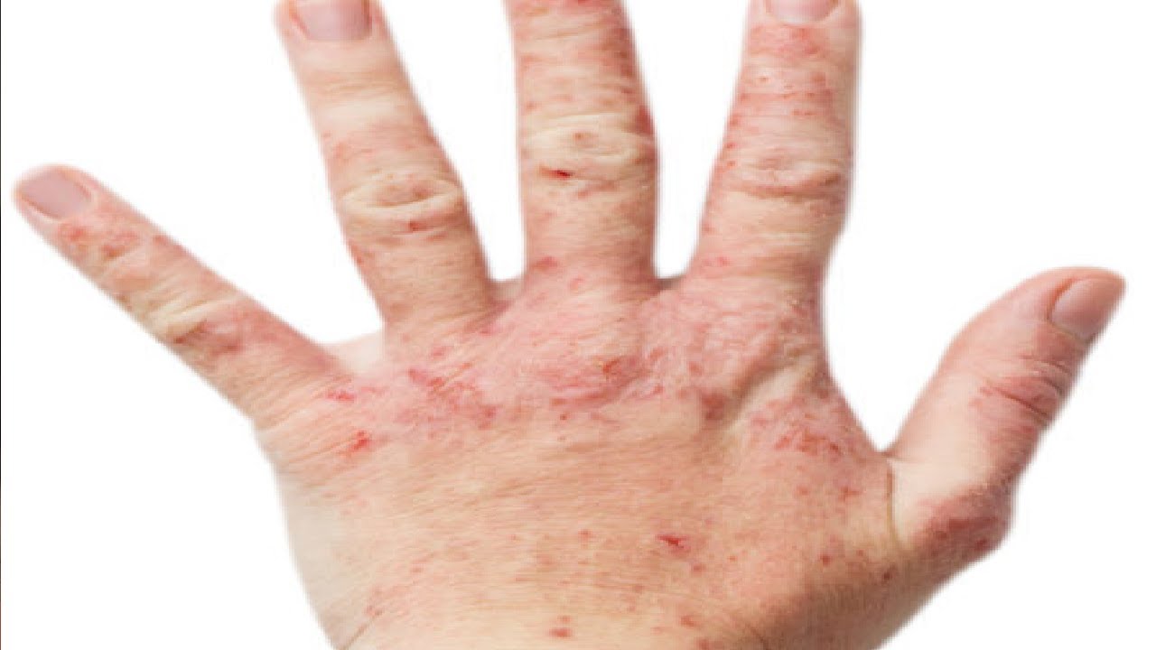 how to get rid of skin rash on hands - YouTube