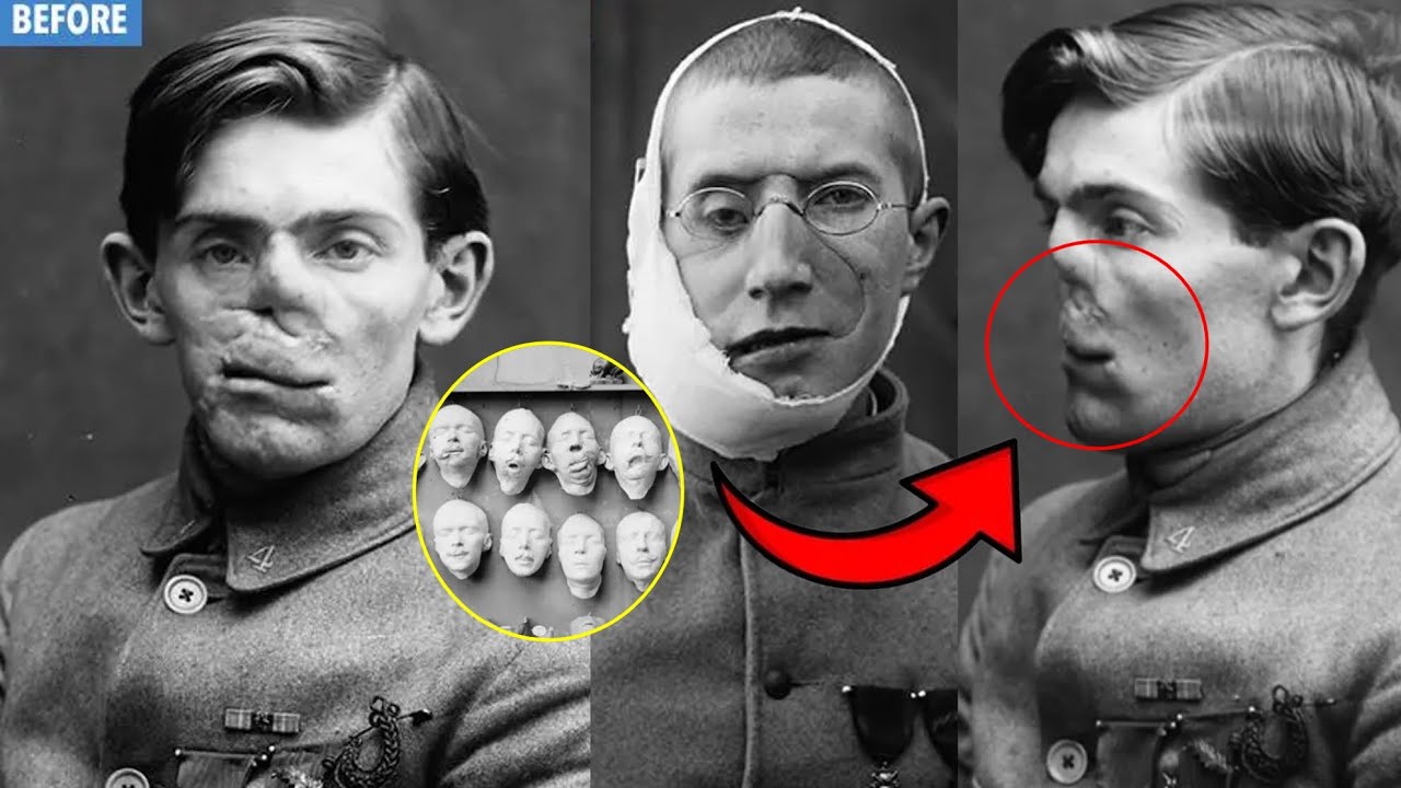 100-year-old photos reveal how injured WW1 soldiers were given MASKS to ...