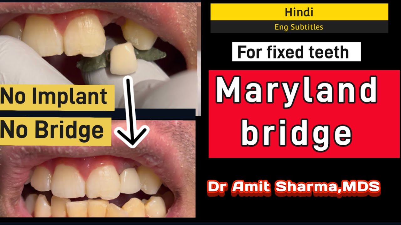 NO IMPLANT, NO BRIDGE | Maryland bridge replacing missing front teeth ...