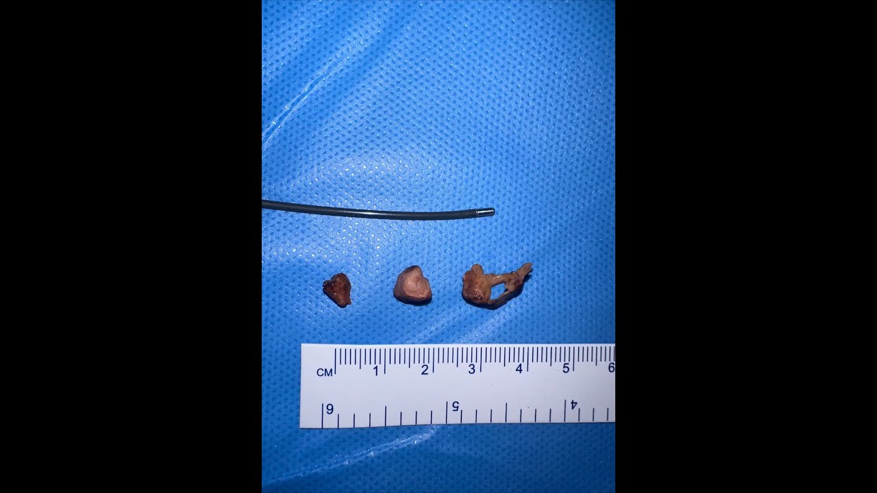 CRYOEXTRACTION - AIRWAY FOREIGN BODY - BEETEL NET - YouTube