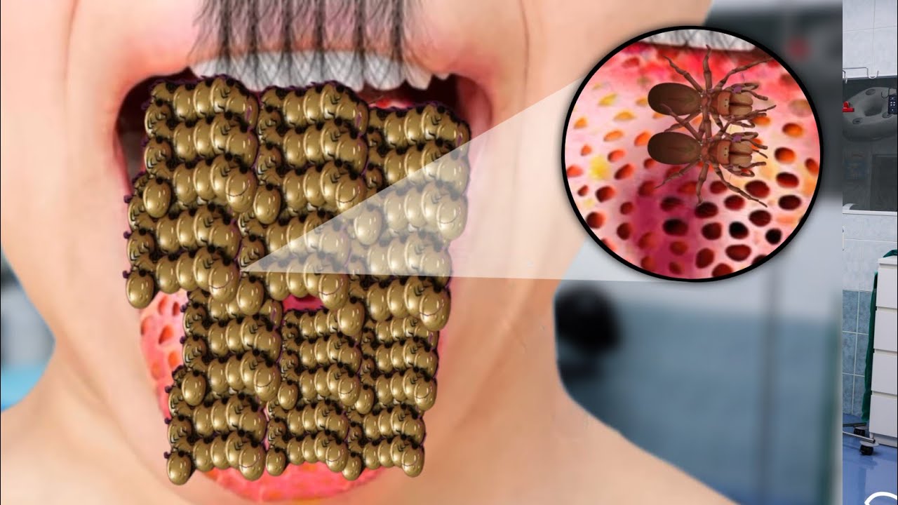 ASMR Remove Mucus & Flies, Maggots in the Nose Severely Injured ...