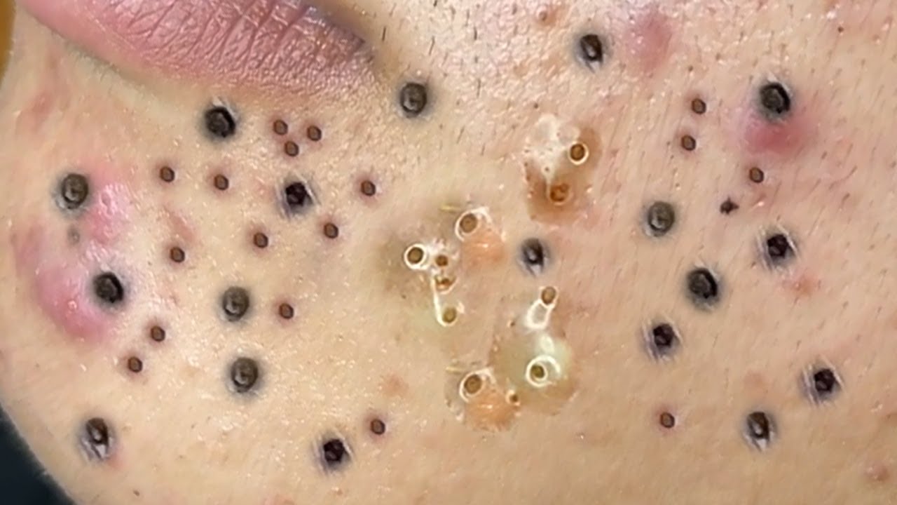 𝐄𝐱𝐭𝐫𝐞𝐦𝐞 𝐁𝐥𝐚𝐜𝐤𝐡𝐞𝐚𝐝 𝐑𝐞𝐦𝐨𝐯𝐚𝐥 𝐚𝐭 𝐋𝐍𝐆 𝐒𝐤𝐢𝐧 𝐂𝐚𝐫𝐞 # 423210 - YouTube