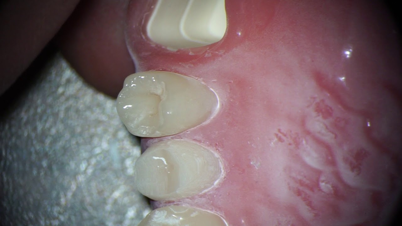 verti prep - YouTube