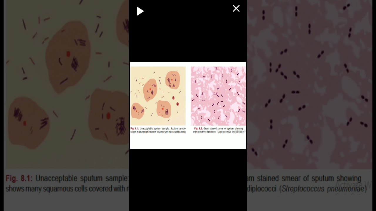 Collection of sputum1 - YouTube