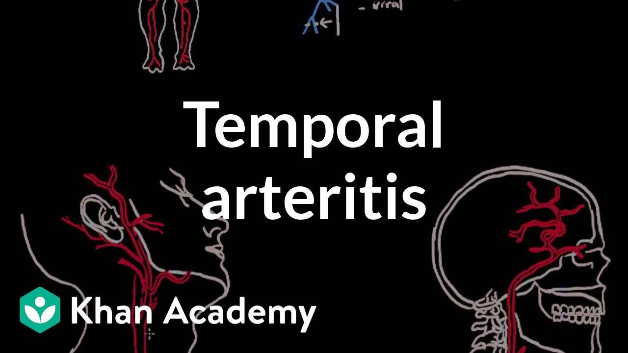 Temporal arteritis | Circulatory System and Disease | NCLEX-RN | Khan ...