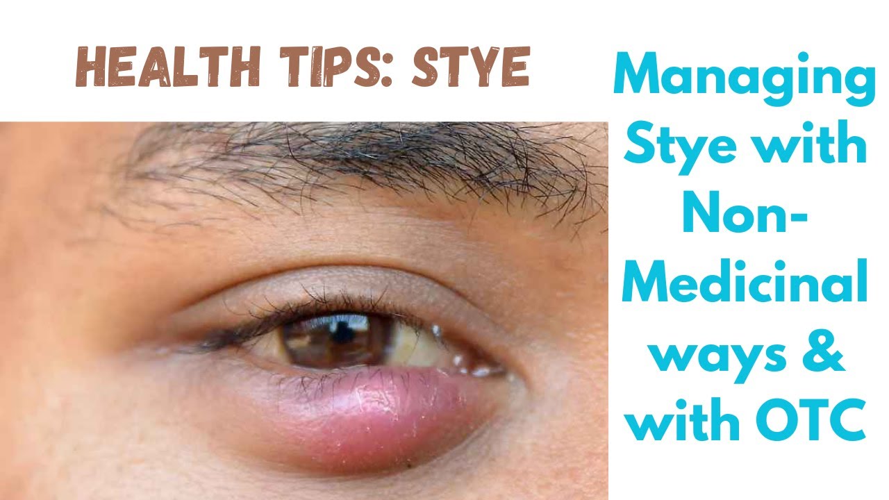 Stye 101 Causes, Management, and Prevention - YouTube