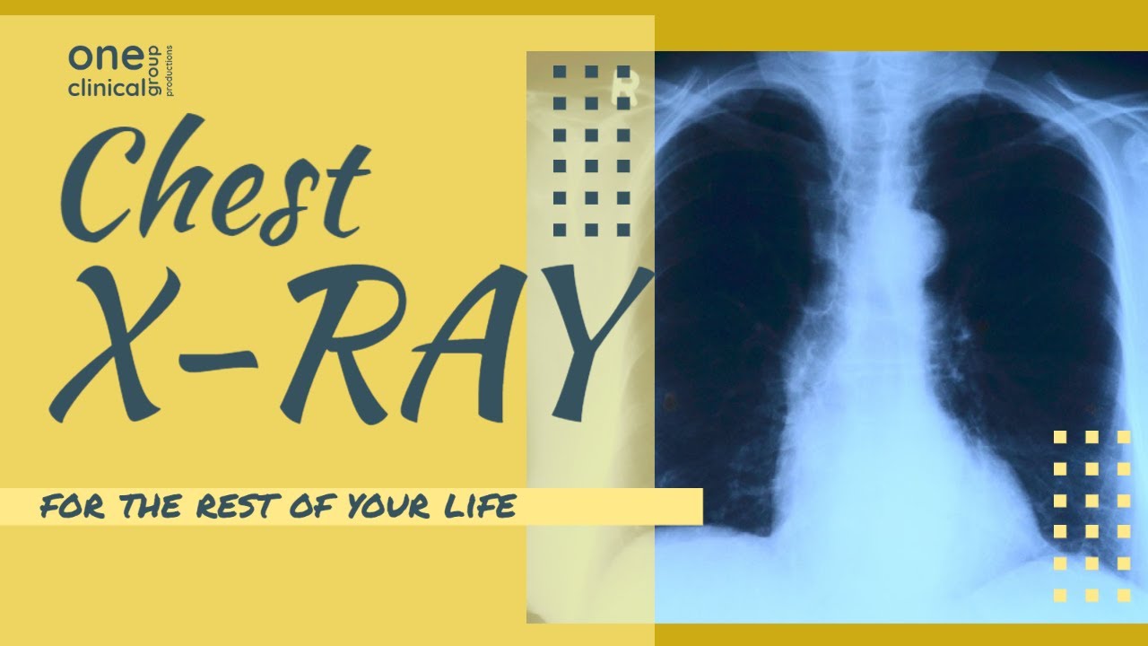 Chest X-Ray - For the Rest of Your Life - Medical Students & Junior ...