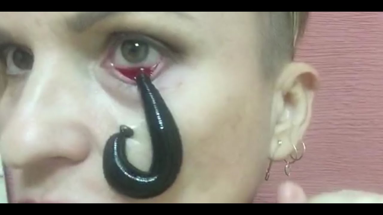 Постановка пиявки в глаз.Гирудотерапия.Putting a leech into the eye ...