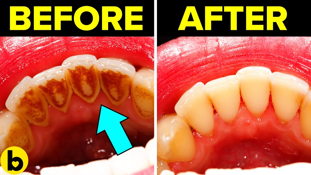 14 Remedies To Fight Against Plaque Naturally - YouTube