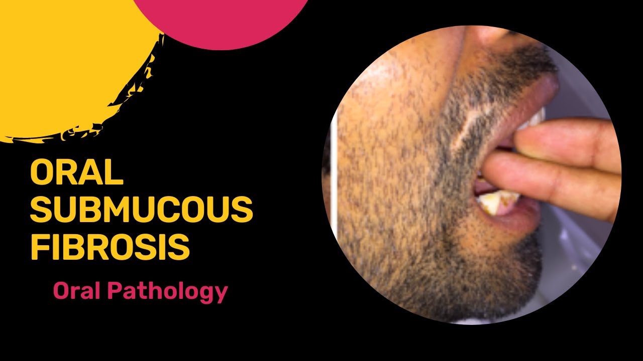OSMF Part 1 | Oral Submucous Fibrosis | Oral Pathology | Neet MDS - YouTube