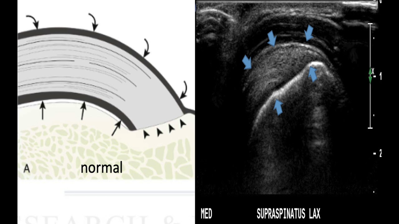 Rotator Cuff tears in Ultrasound - YouTube