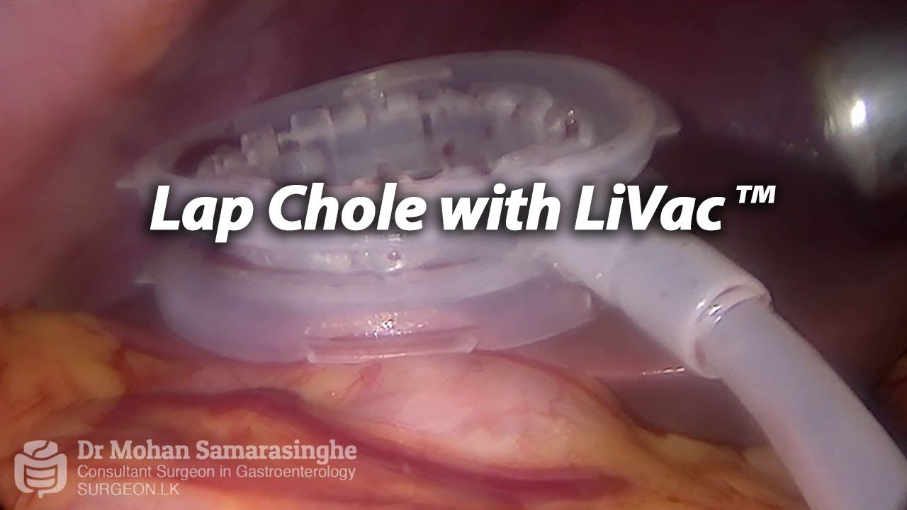 Lap Chole with Livac - Novel Liver Retractor - YouTube