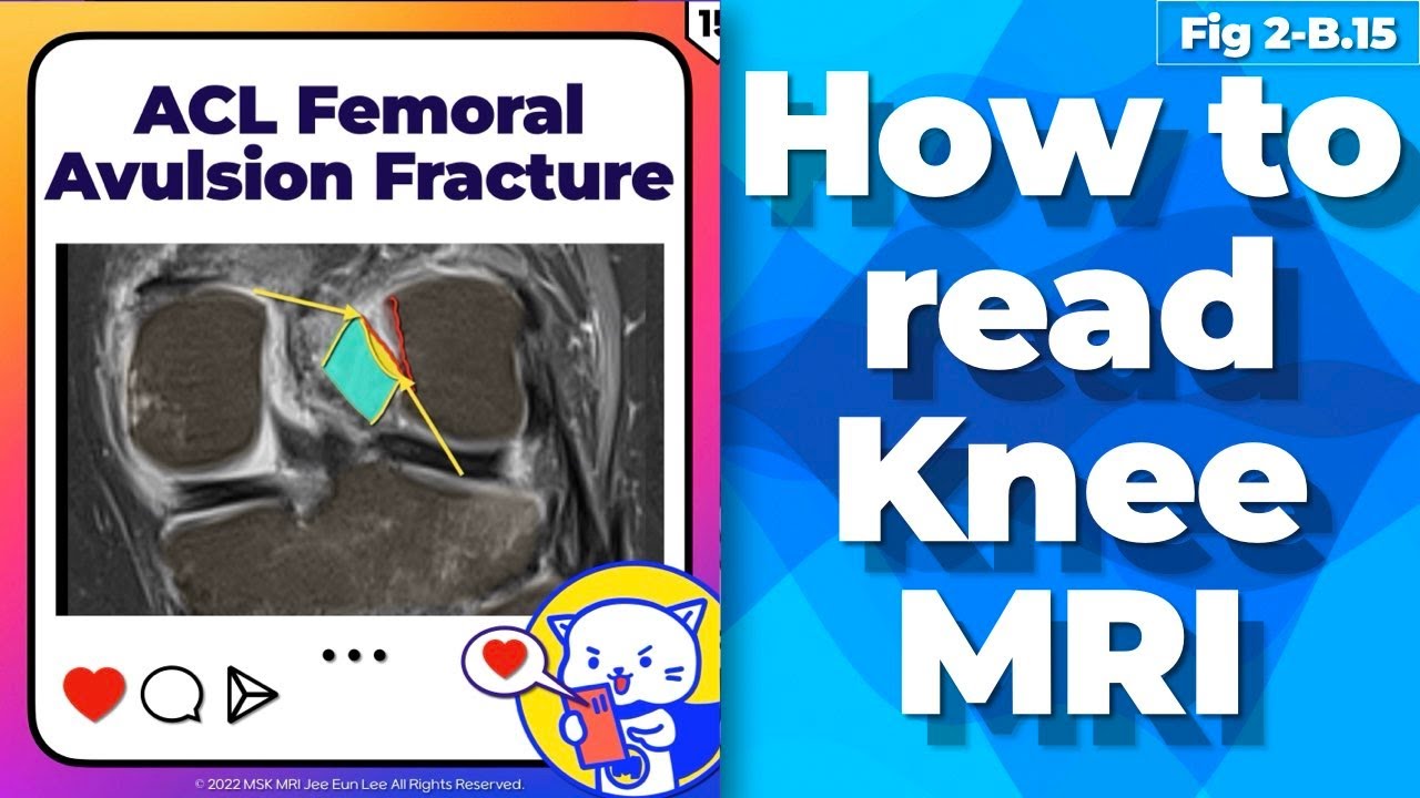 (Fig 2-B.15) ACL Avulsion fracture from the femoral attachment - YouTube
