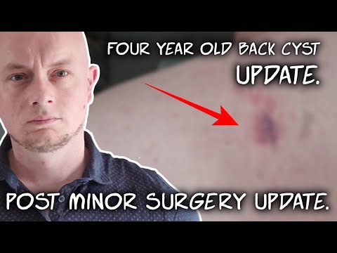 Four year old back Cyst - Post minor surgery update. - YouTube
