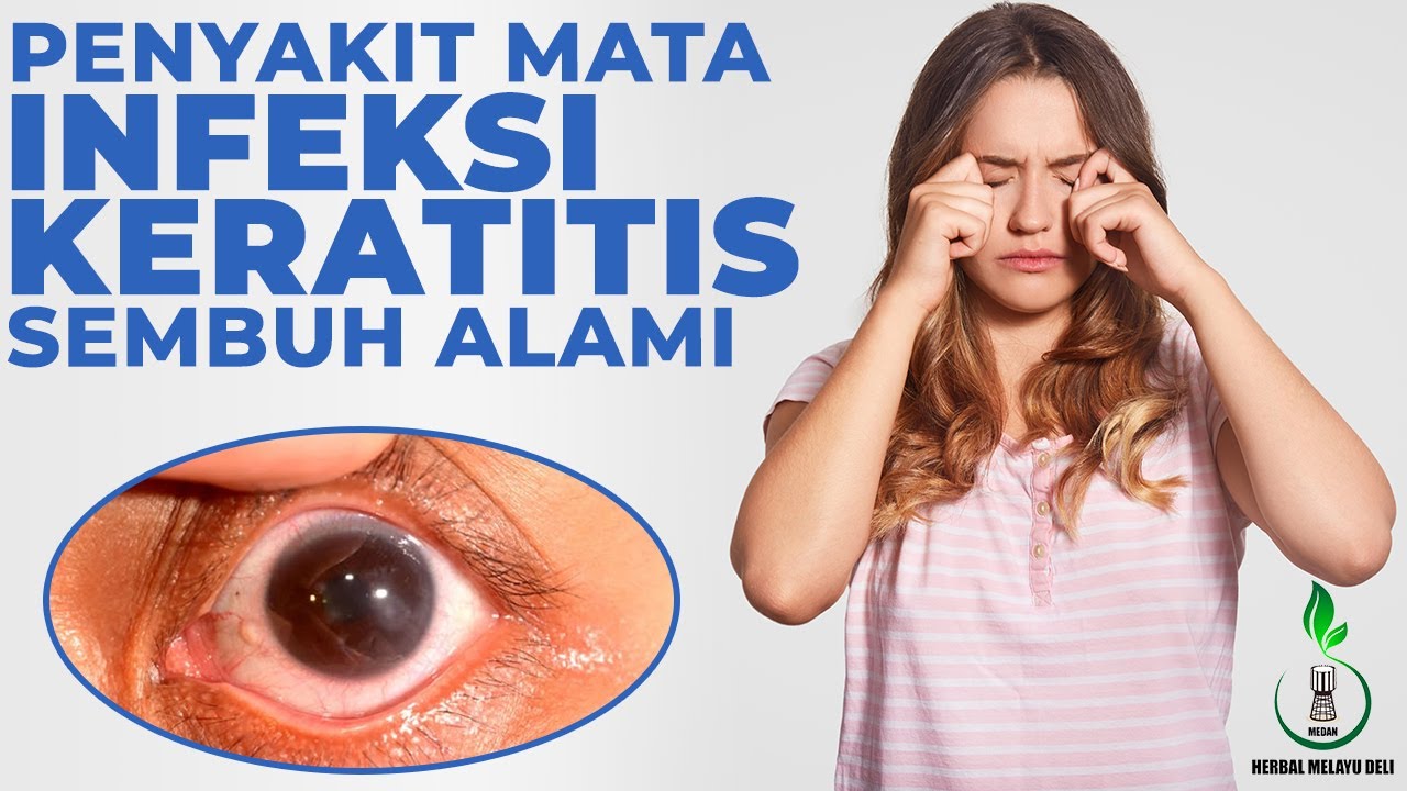 Pengobatan Infeksi Mata Keratitis & Peradangan Kornea Mata || Bisa ...