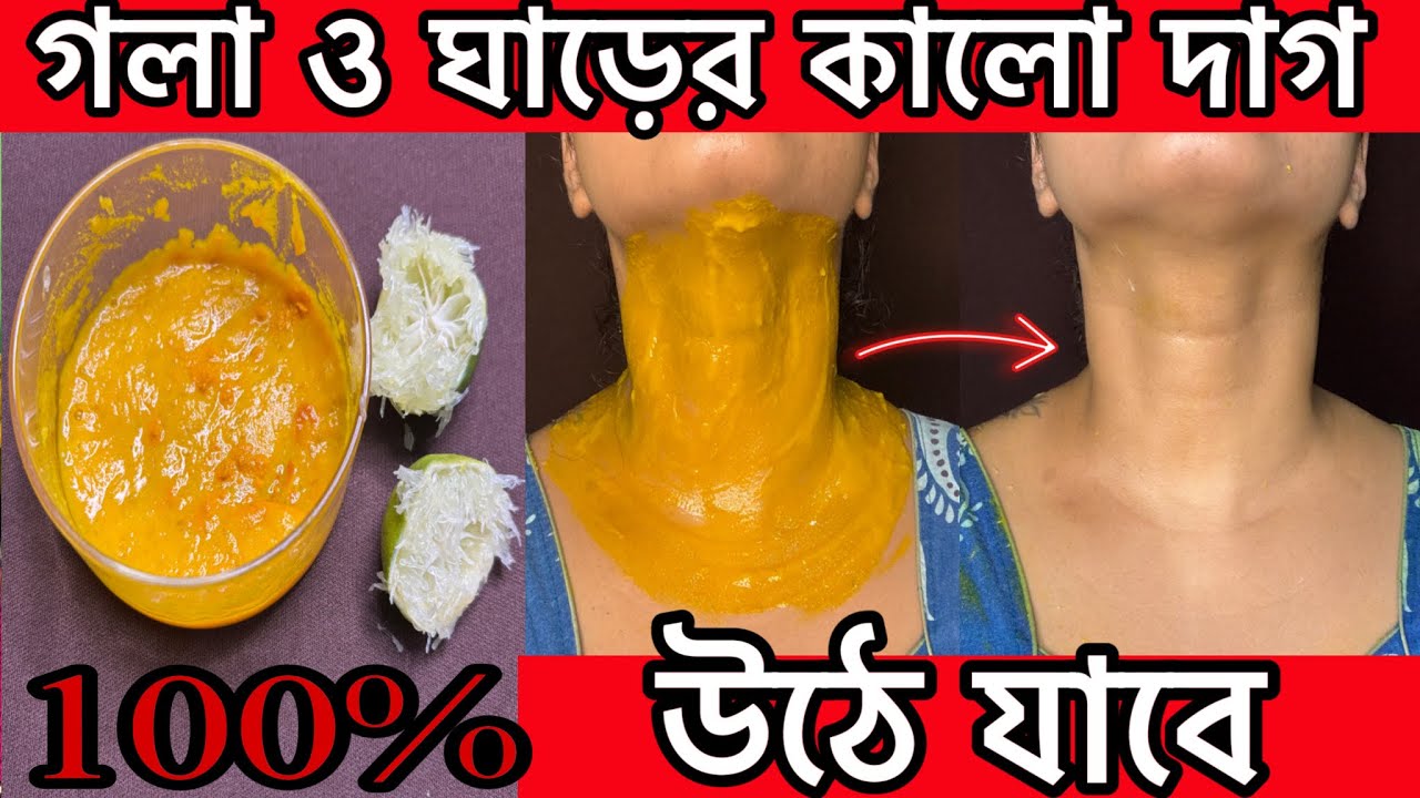 100% গলা ও ঘাড়ের কালো দাগ দূর করার উপায়/gola o gharer kalo dag dur ...