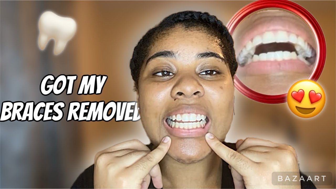 I FINALLY GOT MY BRACES PERMANENTLY REMOVED💓 | why did I get them off ...