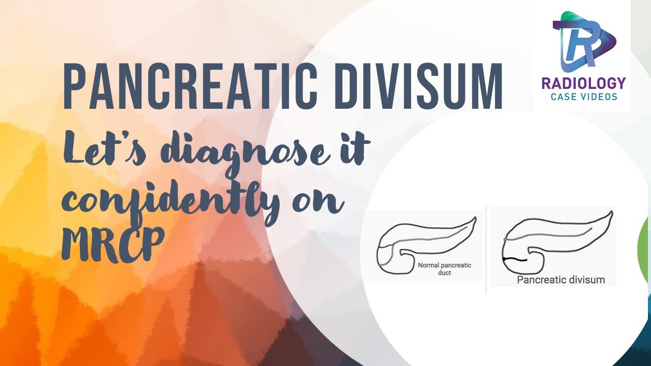 Pancreatic Divisum Radiology