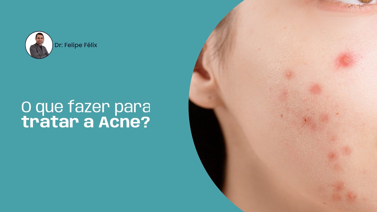 O que fazer para tratar a Acne? - Dr Felipe Félix #naturopatia - YouTube