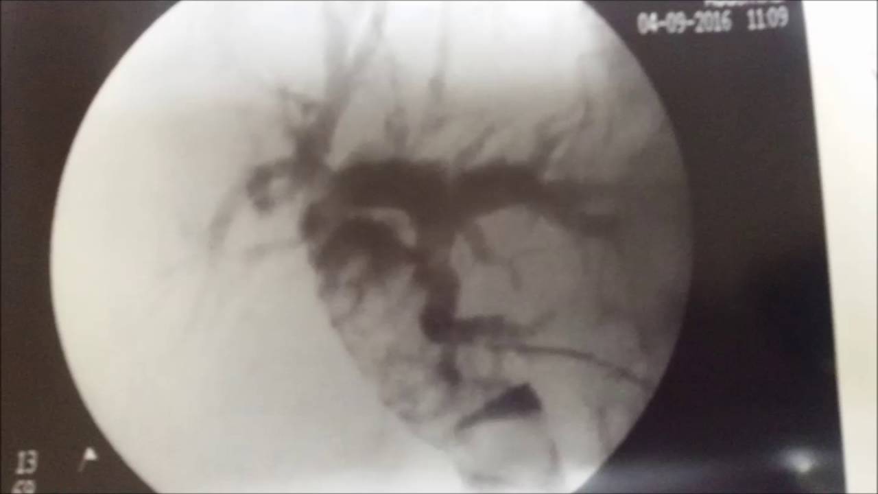 Litiasis Coledociana Multiple - YouTube
