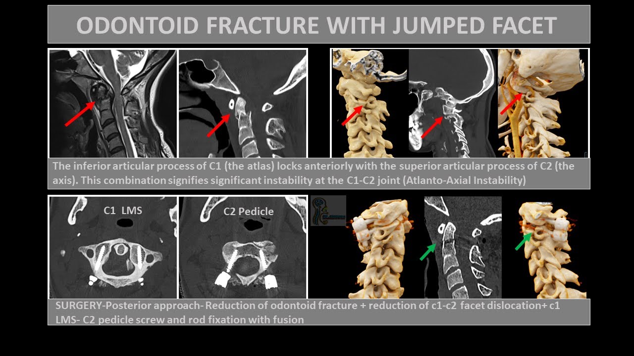 Odontoid fracture with Jumped facet| Atlantoaxial instability| C1-C2 ...