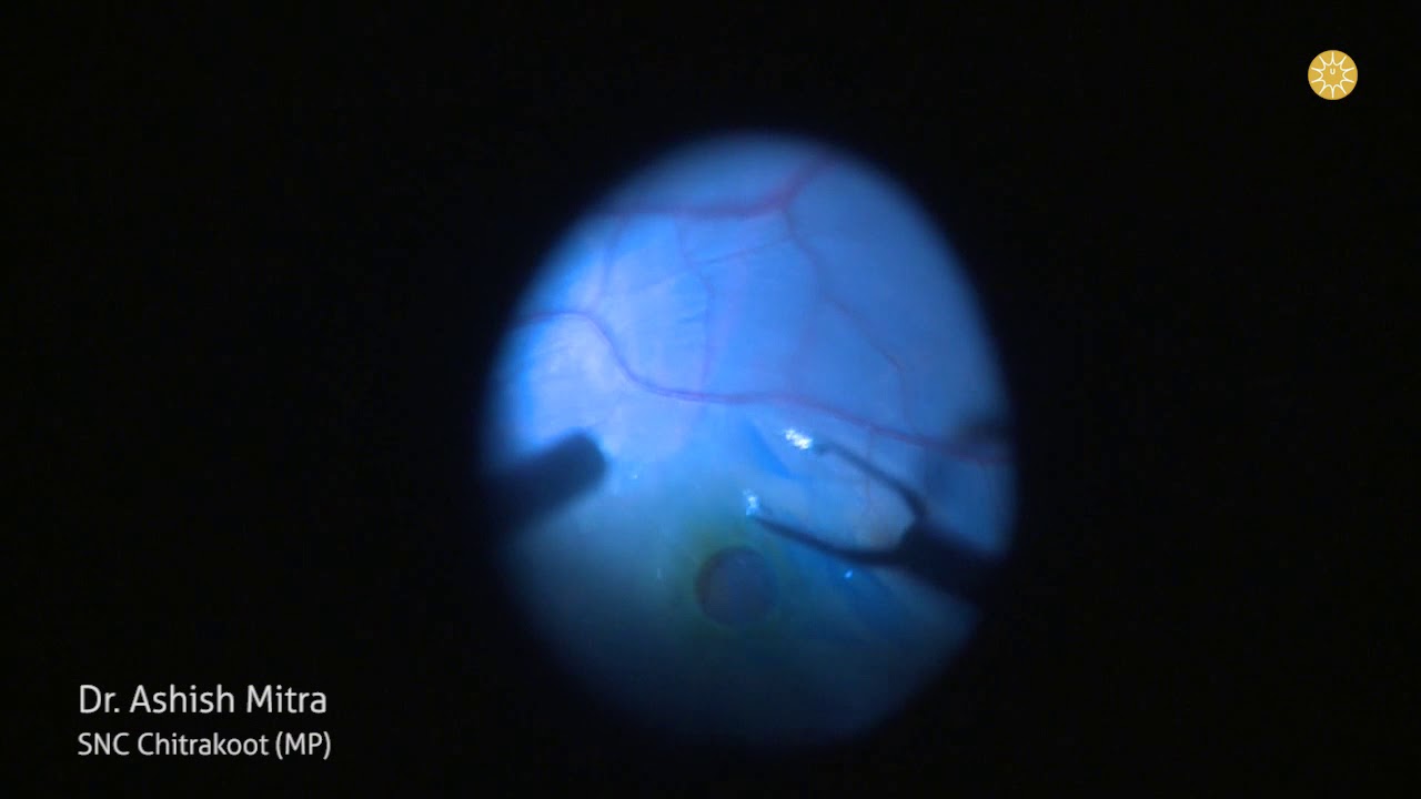 ILM peeling (Inverted flap) large macular hole - Dr Ashish Mitra - YouTube