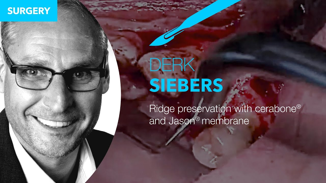 Ridge preservation with cerabone® and Jason® membrane - YouTube